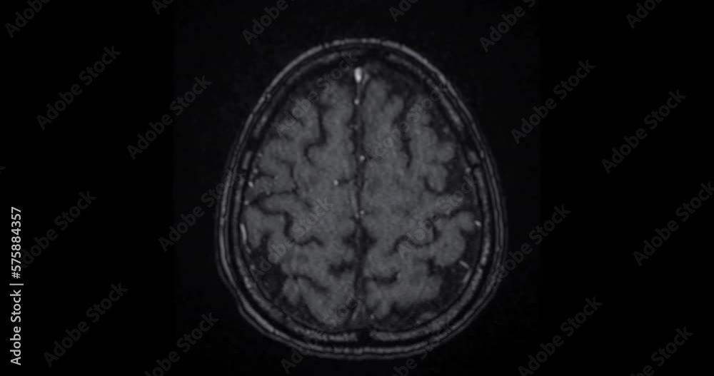 MRI Brain Axial TOF can help doctors look for conditions such as ...