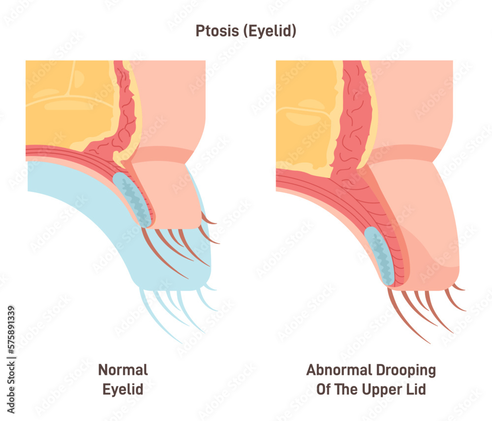 Ptosis. Drooping of the upper eyelid. Lazy eye caused by weakened Stock ...
