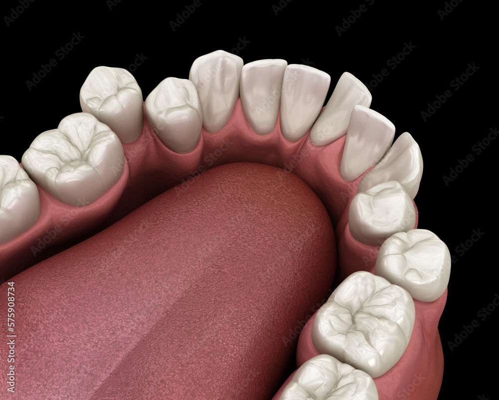 Overcrowded teeth, abnormal dental occlusion. Medically accurate tooth ...