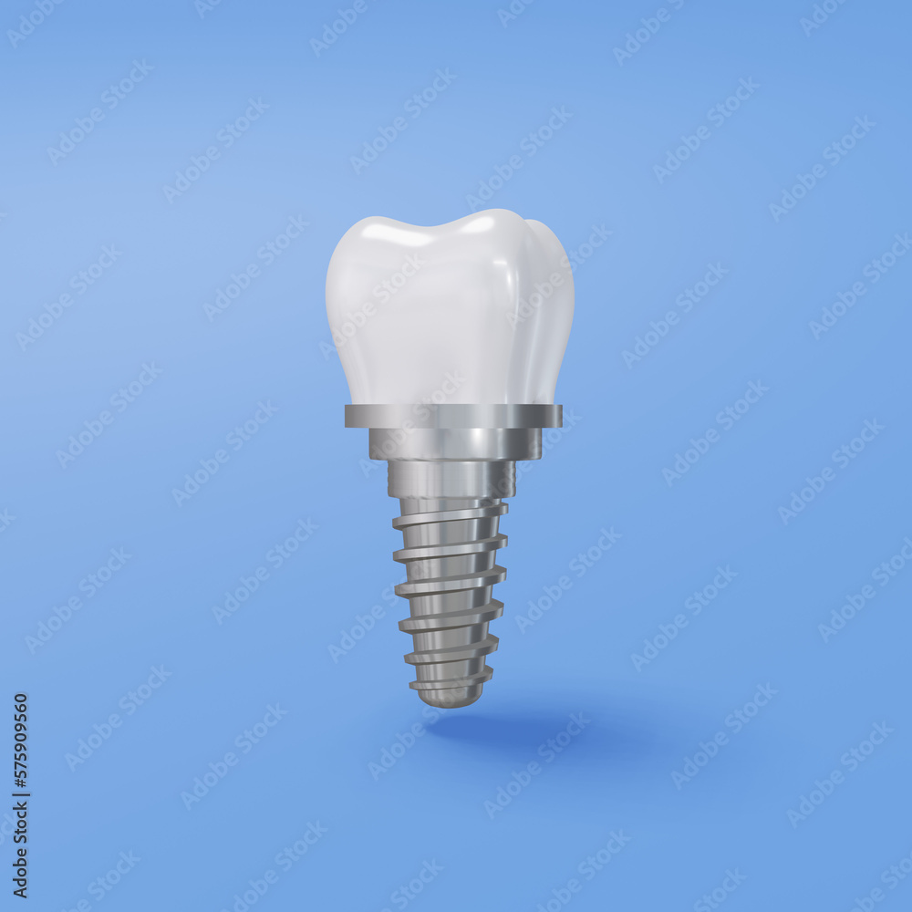 Dental implant 3d render on blue background. Tooth. Render. Dentistry ...