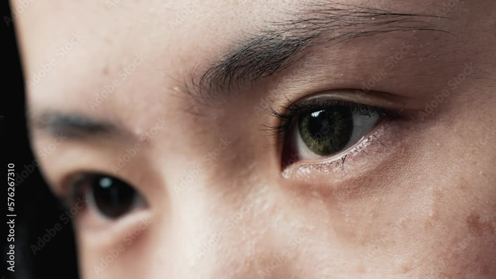 Young Asian Woman with Crying Eye with Heterochromia Looking Sad in ...