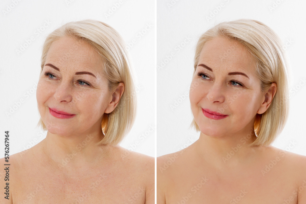 Closeup before after Beauty middle age woman face portrait. Before ...