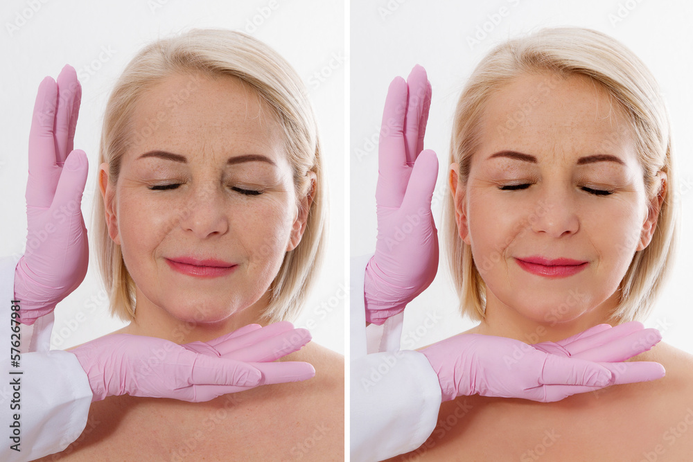 Closeup before after Beauty middle age woman face portrait. Before ...
