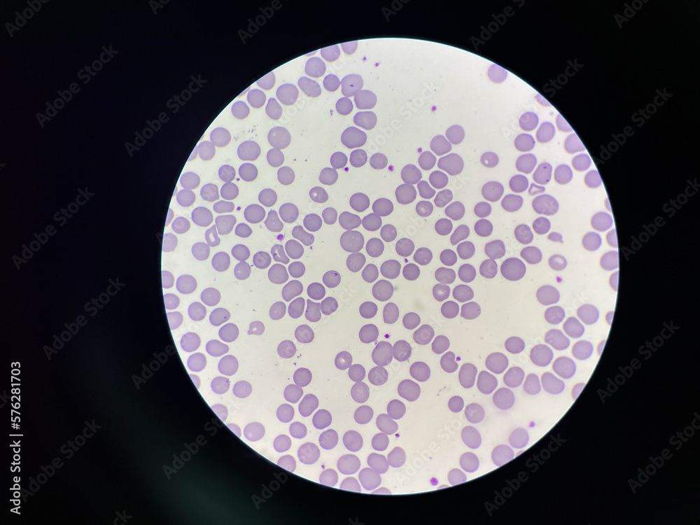 Abnormal red blood cells morphology macrocyte. Stock Photo | Adobe Stock