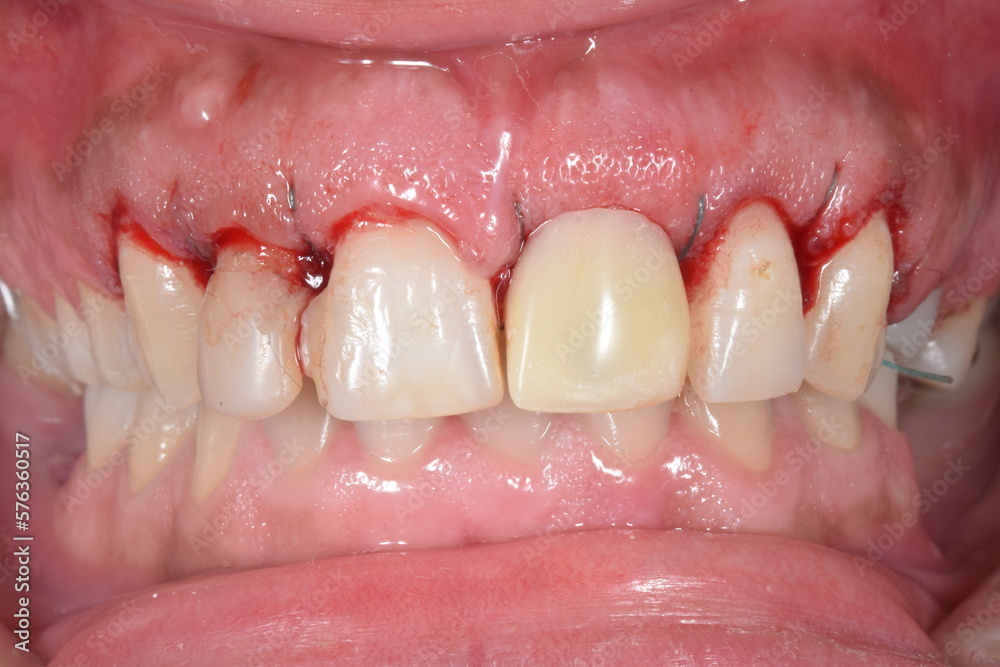 Foto de Dentistry patient with esthetical condition, bad composite ...