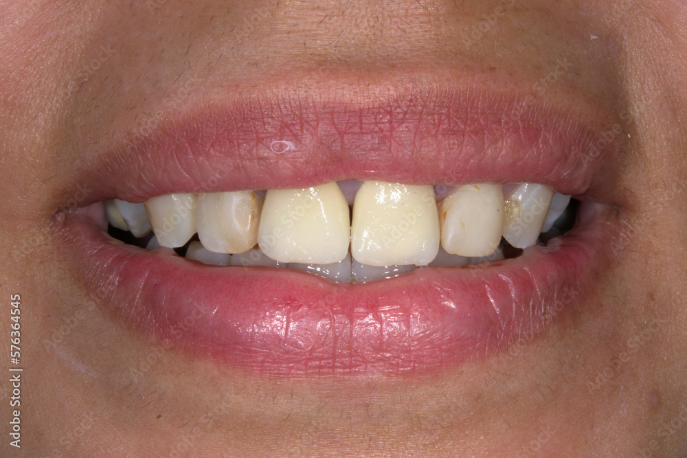 Frontal view of a woman mouth smiling with fake teeth fixed prosthetic ...