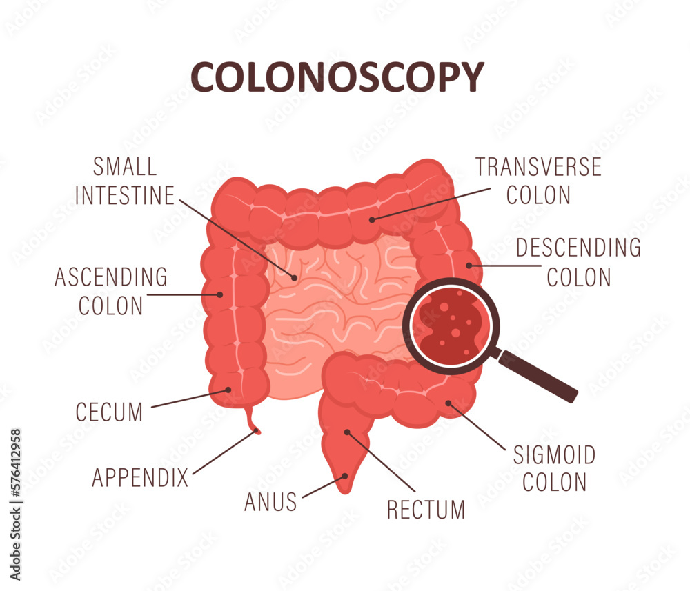Colonoscopy concept. Intestine exam and treatment. Bowel polypectomy ...
