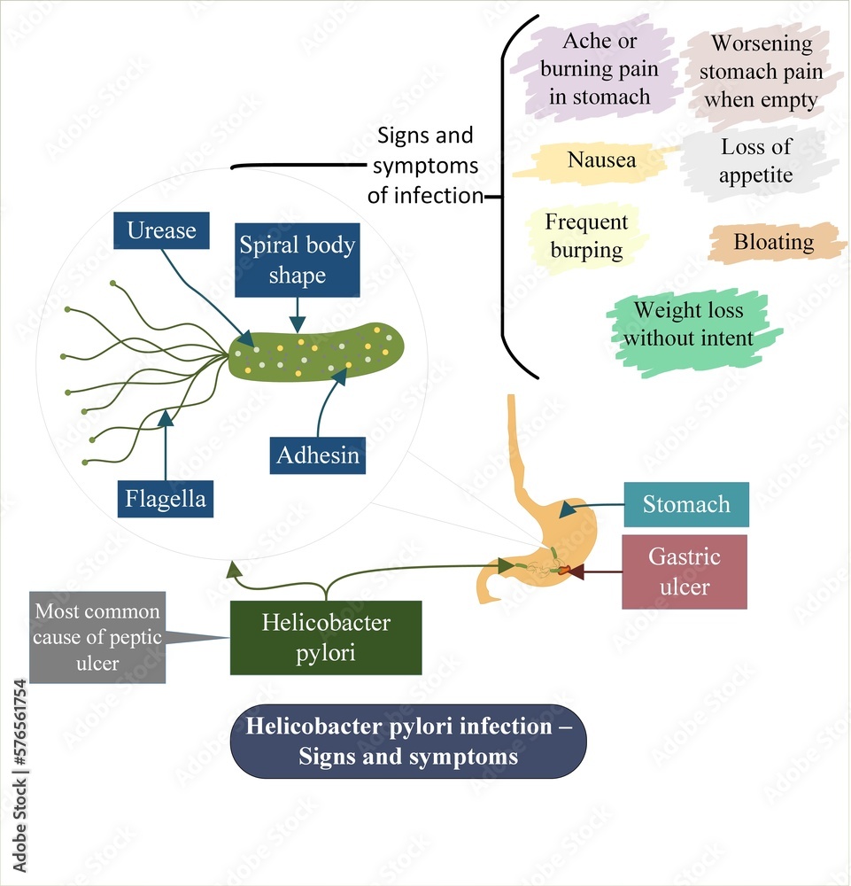 Signs and symptoms associated with Helicobacter pylori infection Stock ...