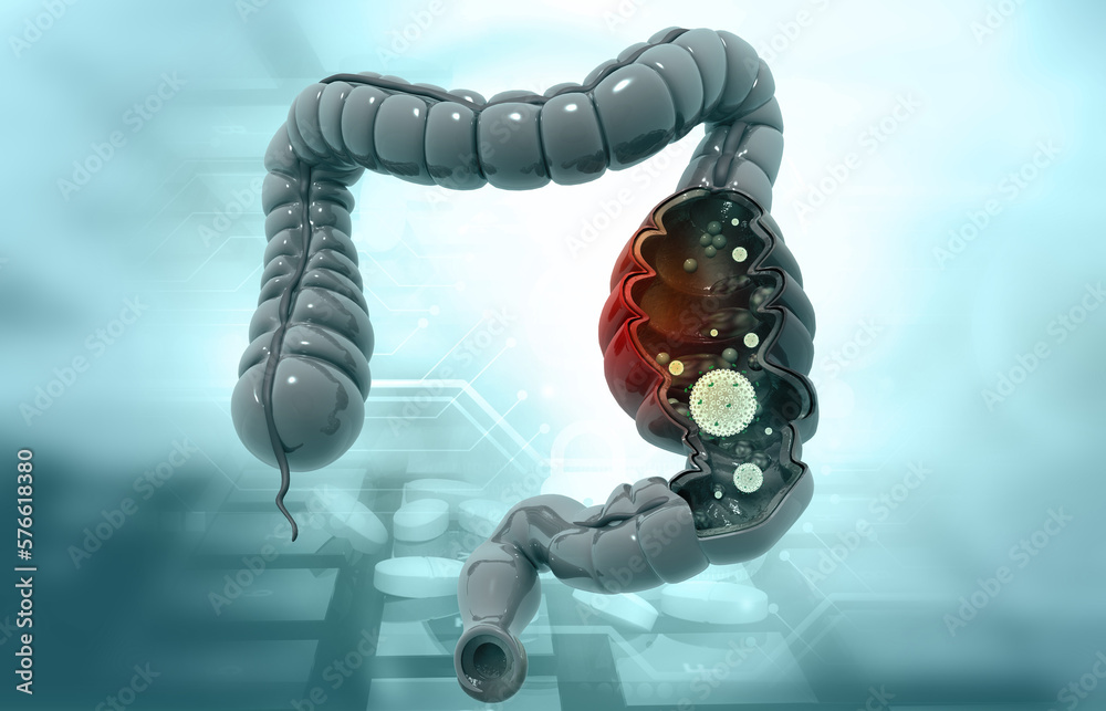 Diseased human colon cross section anatomy. 3d illustration. Stock ...