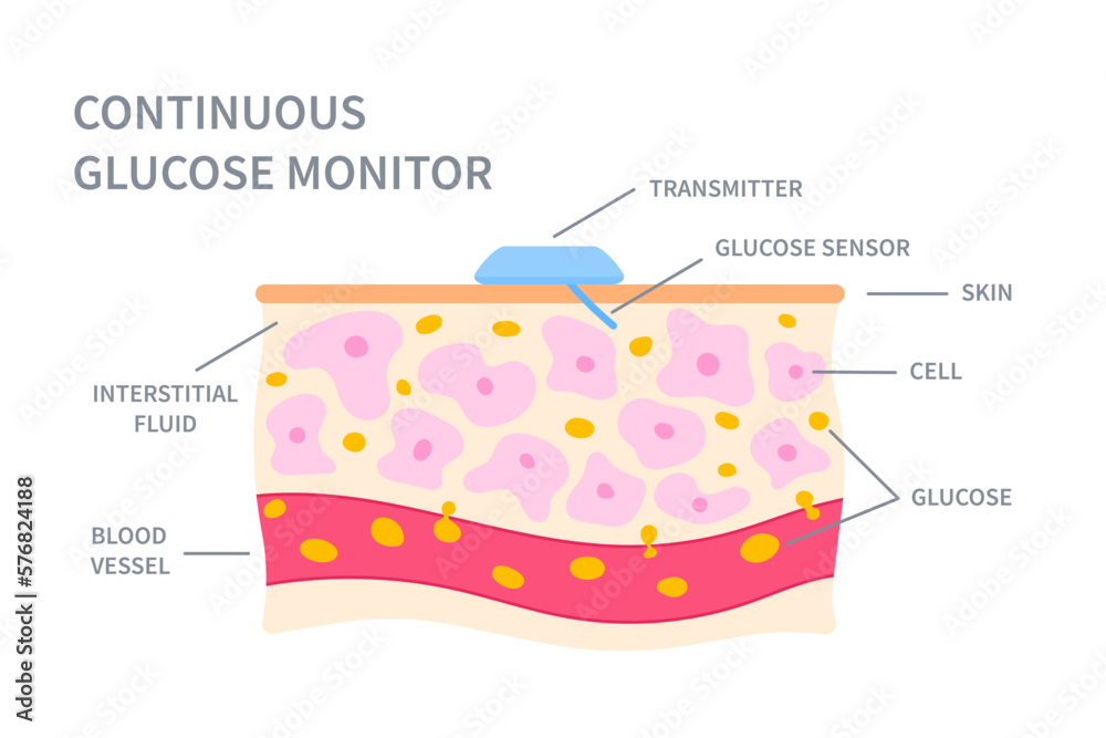 Continuous glucose sugar monitor. Glucometer wireless transmeter. CGM ... Continuous glucose sugar monitor. Glucometer wireless transmeter. CGM ...
