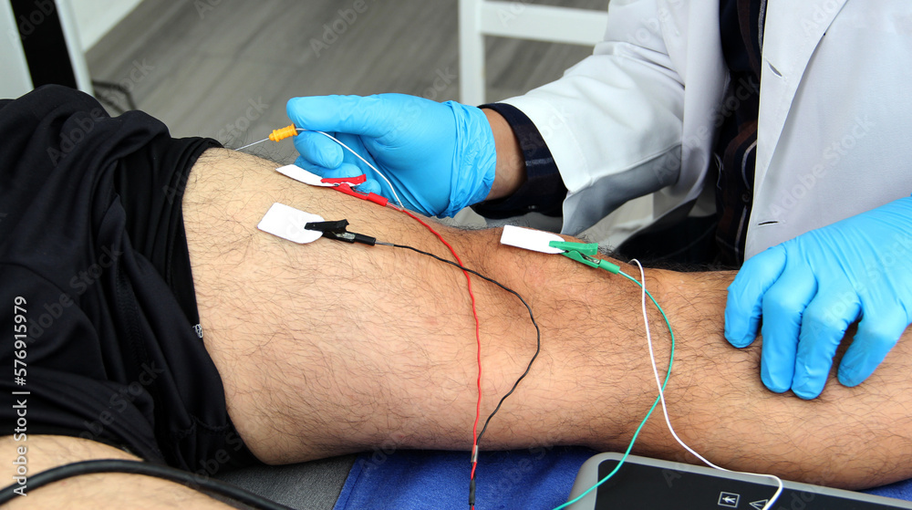 Electromyography EMG and Somatosensory Evoked Potential PEV of lower ...