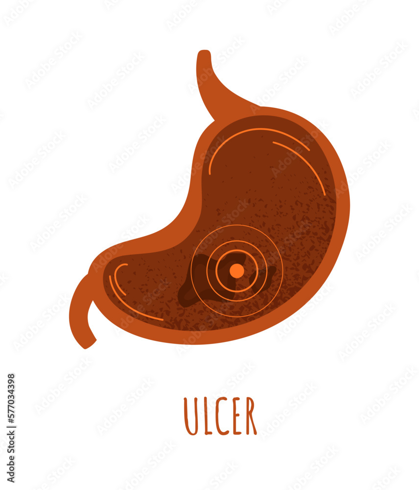 Ulcer in stomach concept. Chronic diseases of abdominal cavity ...