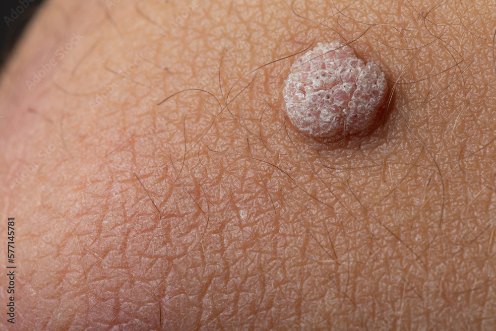 close up of skin, Zoomed-in Shot of Wart on Arm Stock-Foto | Adobe Stock