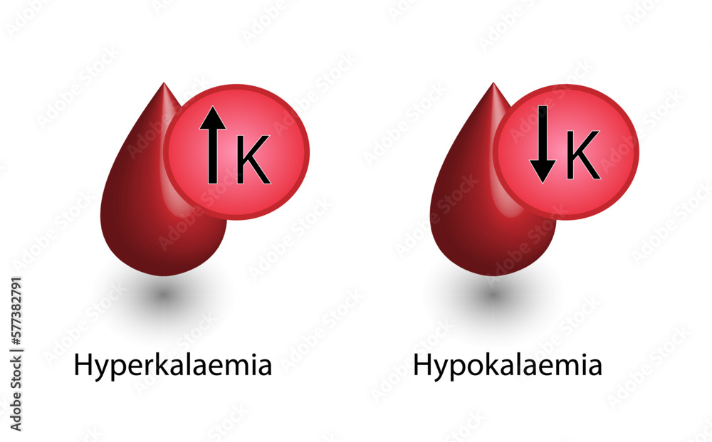 Hyperkalaemia, high plasma potassium level and Hypokalaemia, low plasma ... Hyperkalaemia, high plasma potassium level and Hypokalaemia, low plasma ...