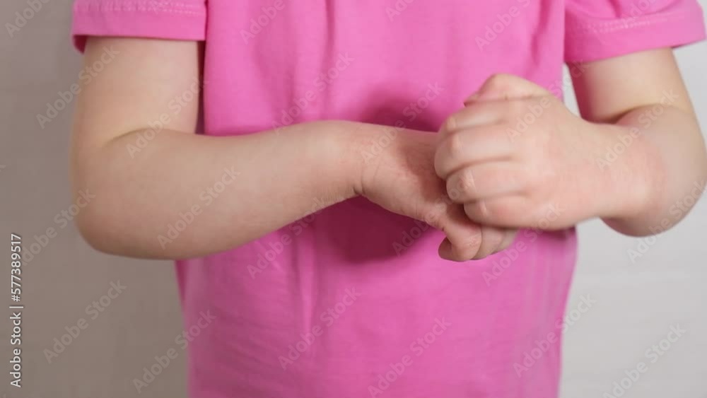 atopic dermatitis concept, a girl scratches the skin of her hands ...