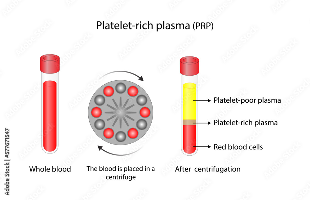 Platelet-rich plasma (prp). Autologous conditioned plasma, is a ...