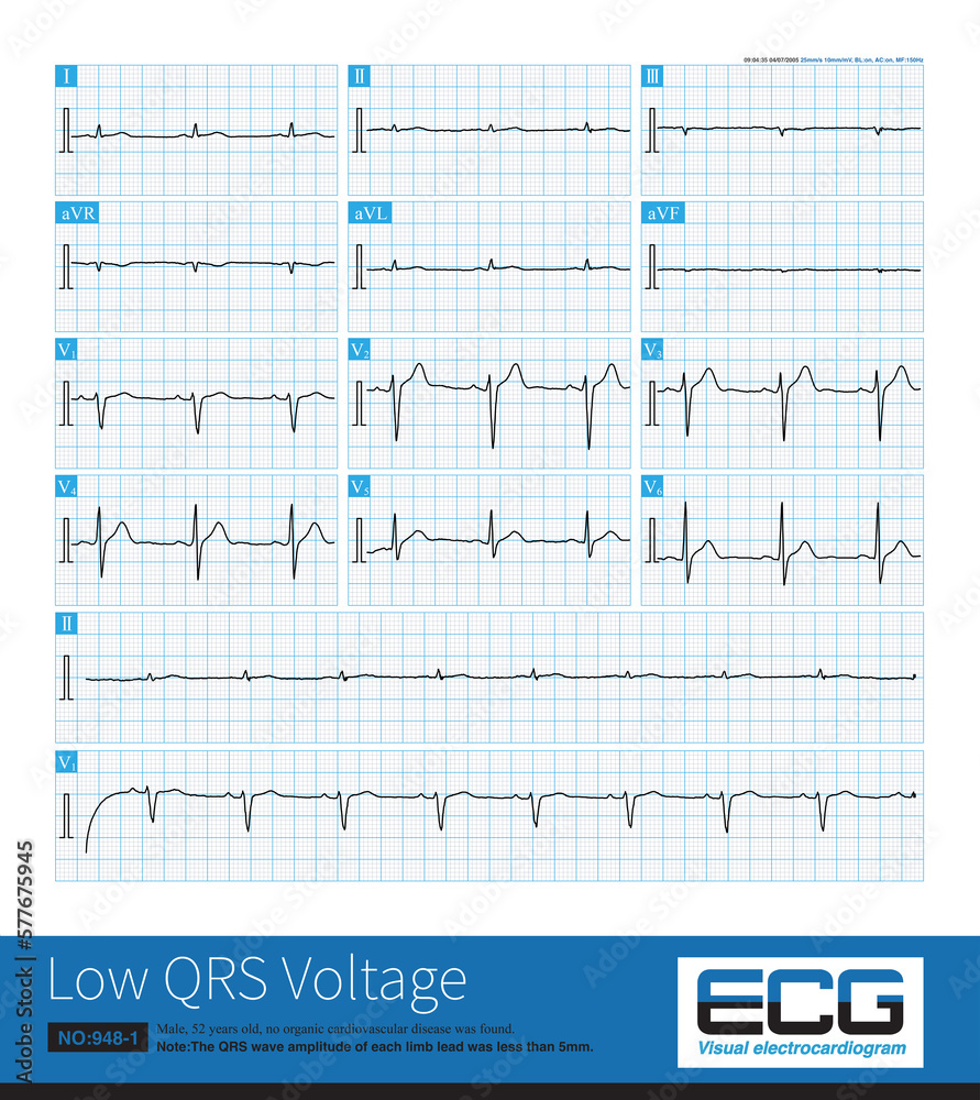 The QRS wave amplitude of each limb lead is less than 5mm, which is ...