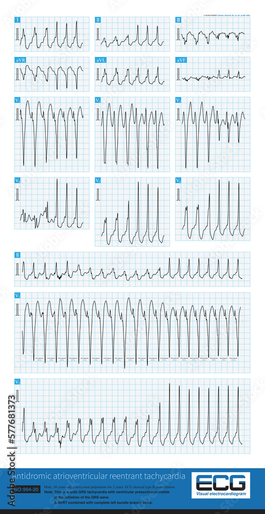 Atrioventricular accessory pathway is a cause of wide QRS tachycardia ...