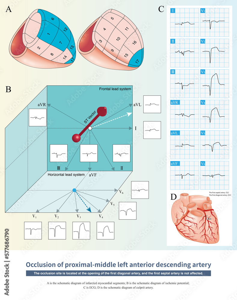 When the first diagonal branch of the LAD is occluded, the ischemic ...