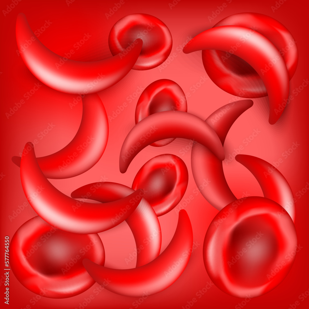Sickle cell disease. SCD. red background. Anemia or anaemia. Stock ...
