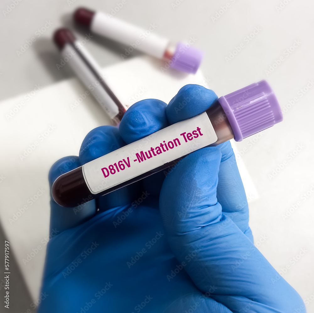 Blood sample for KIT(D816V) mutation testing, to diagnosis of acute ...
