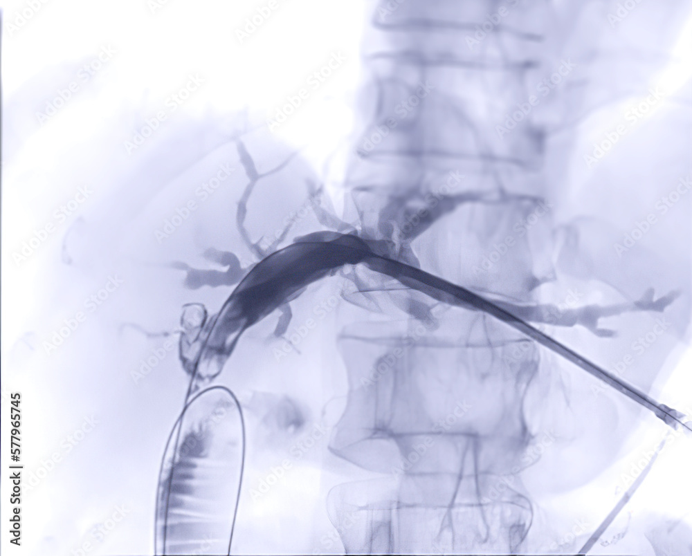 X-ray image of portal vein after Doctor doing ERCP and laparoscopic ...