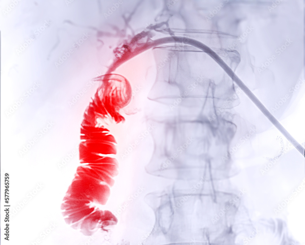 X-ray image of portal vein after Doctor doing ERCP and laparoscopic ...