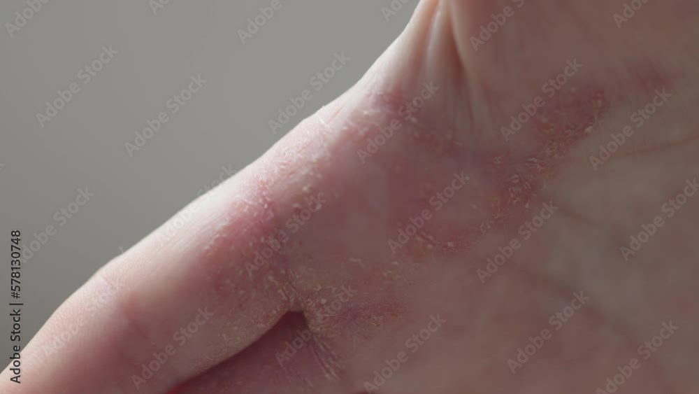 close-up dry cracked skin palm hand inflammation psoriasis dermatitis ...