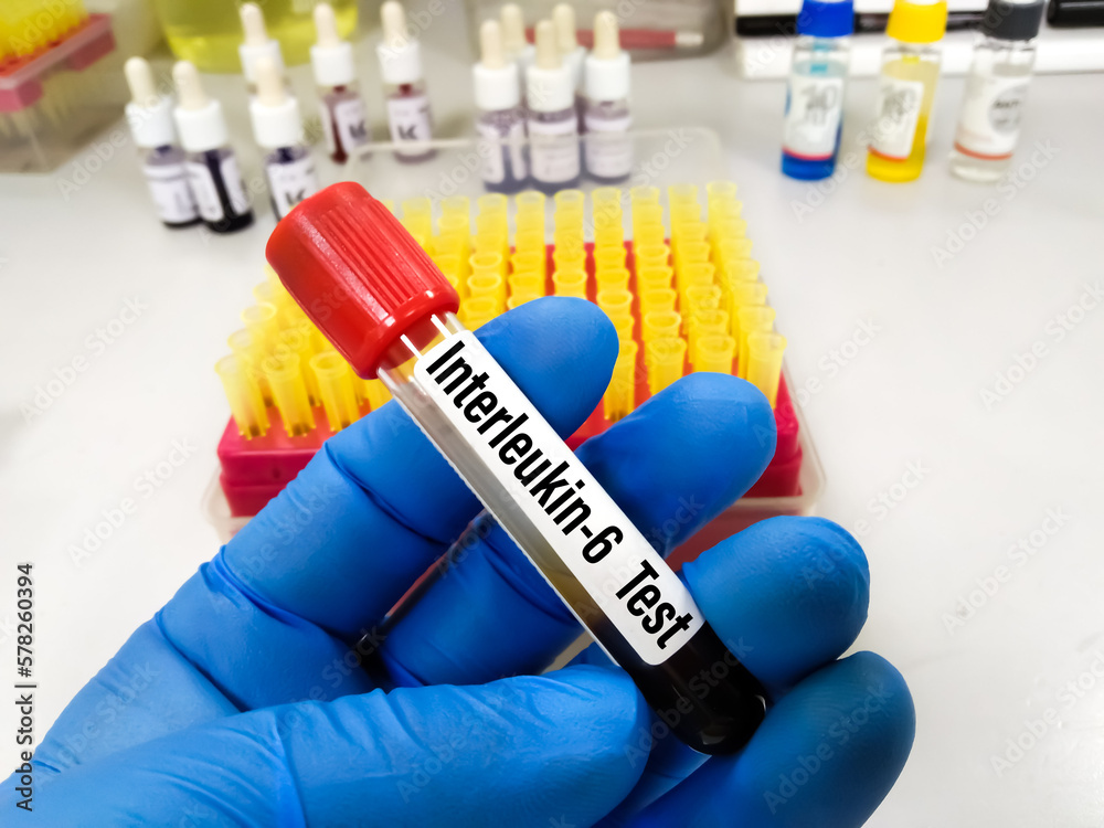 Blood sample tube for Interleukin 6 or IL-6 test, inflammatory cytokine ...