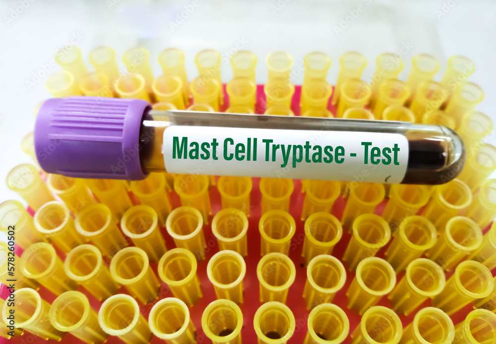 Blood sample tube for Mast cell Tryptase test. A Tryptase test can help ...