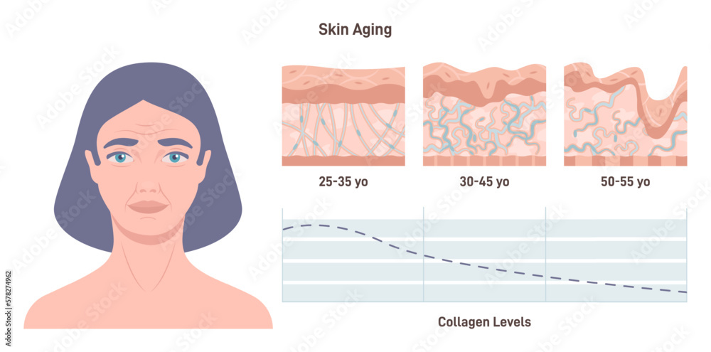 Póster Aging process and the reduction of collagen levels in the skin – Cuadro para Pared ...