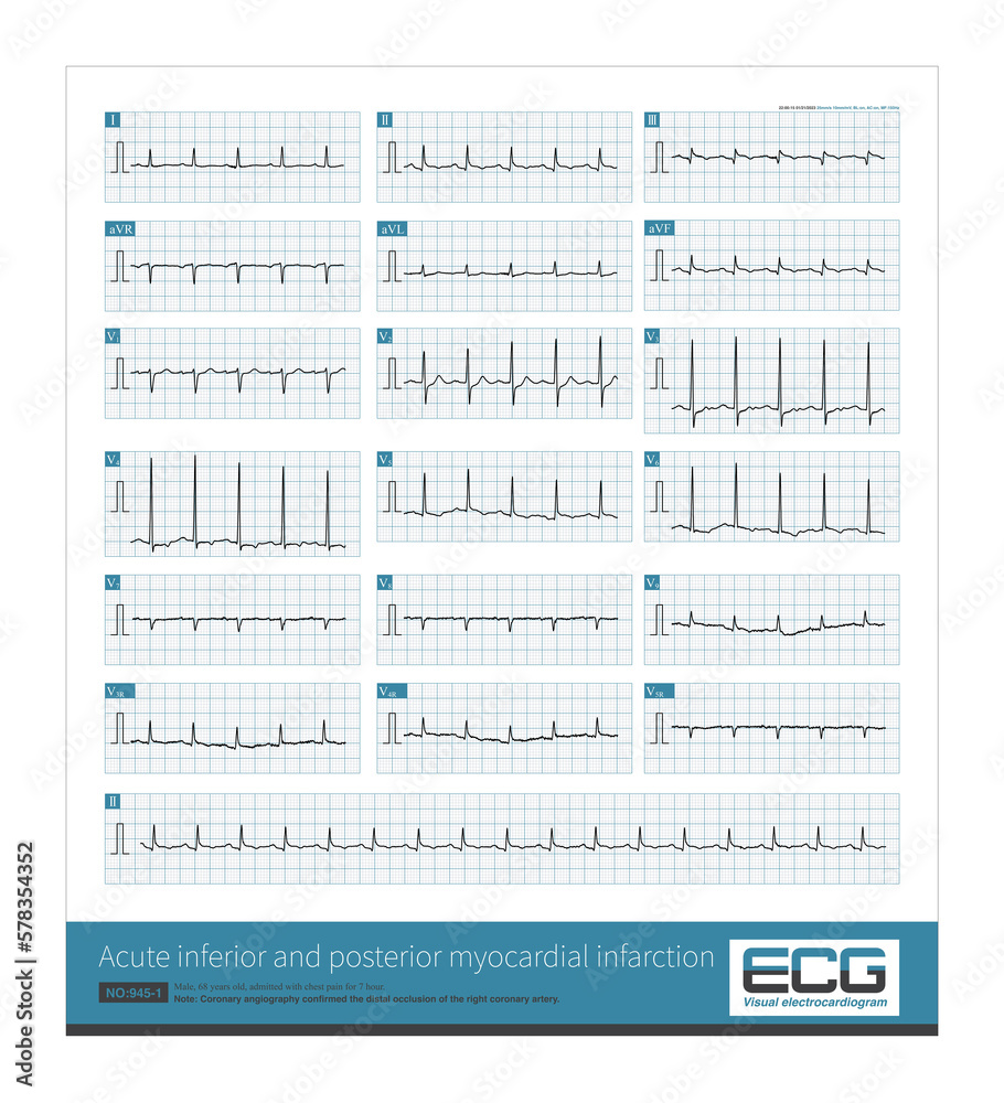 Distal occlusion of the right coronary artery can cause inferior and ...