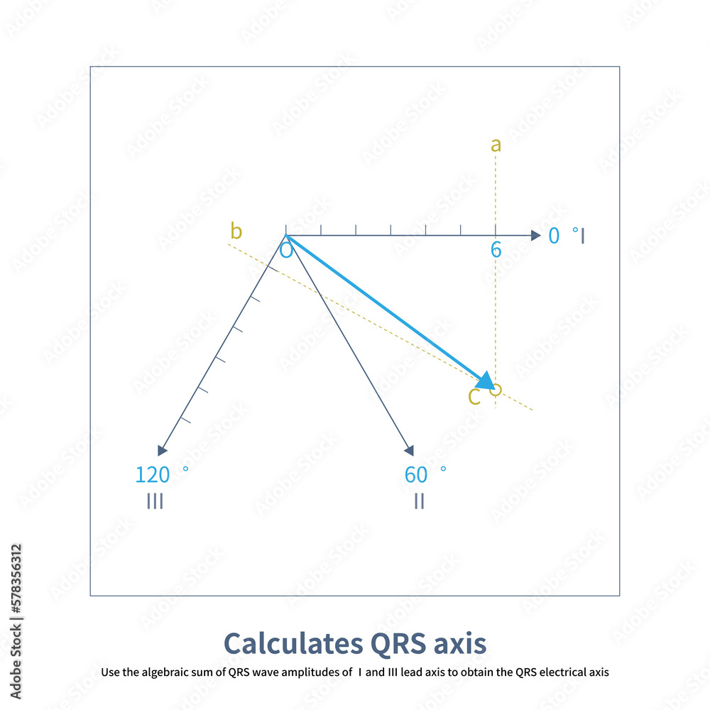 Mark the algebraic sum of QRS amplitudes of lead Ⅰ and Ⅲ on the lead ...