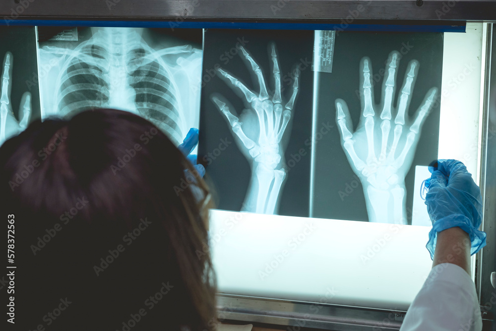 A female radiologist checks the x-rays of the ribs and hands of a patient. Conventional x-ray ...