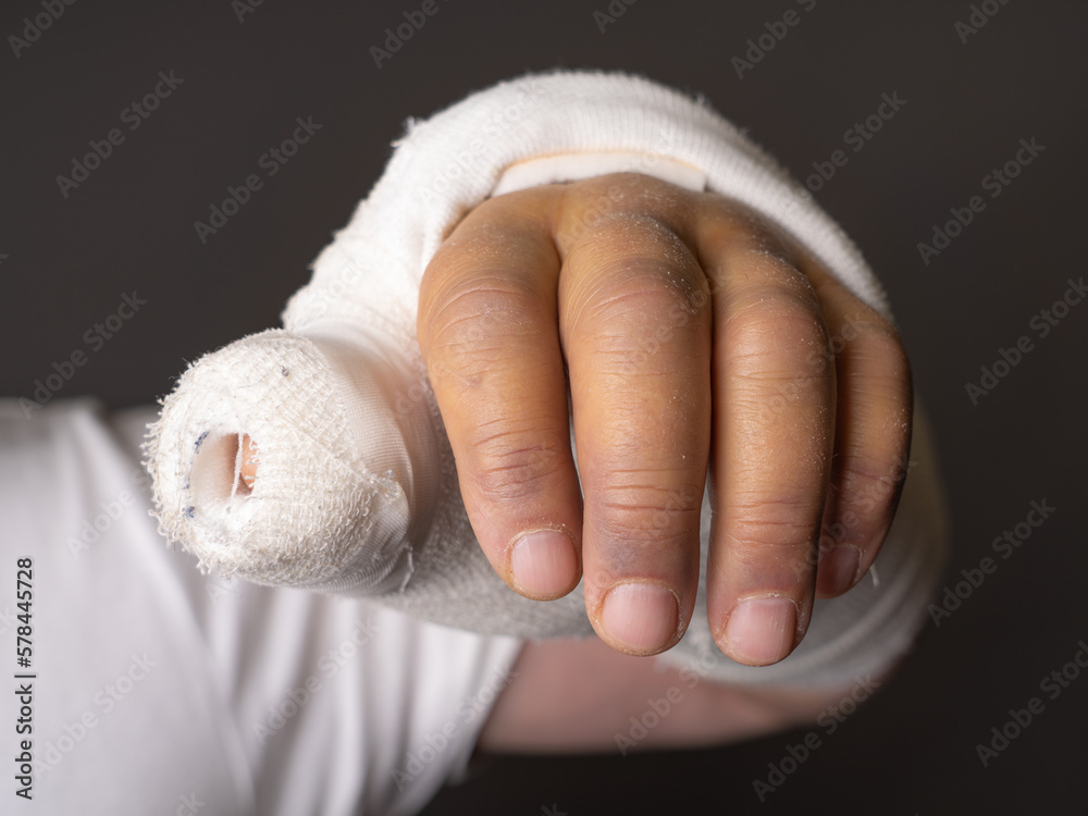 Hand in plaster, big bruise on hand. Cropped photo of a man. After ...