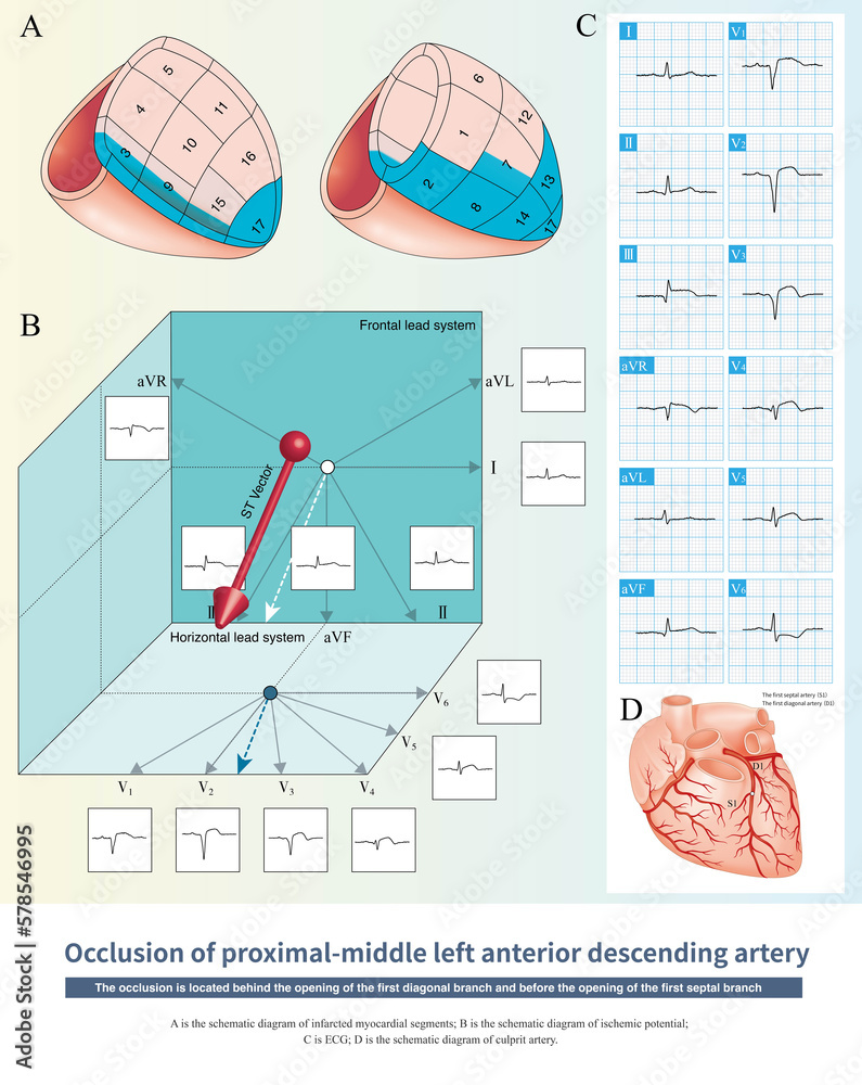 When The Occlusion Of The Lad Affects The First Septal Branch And The First Diagonal Branch Is