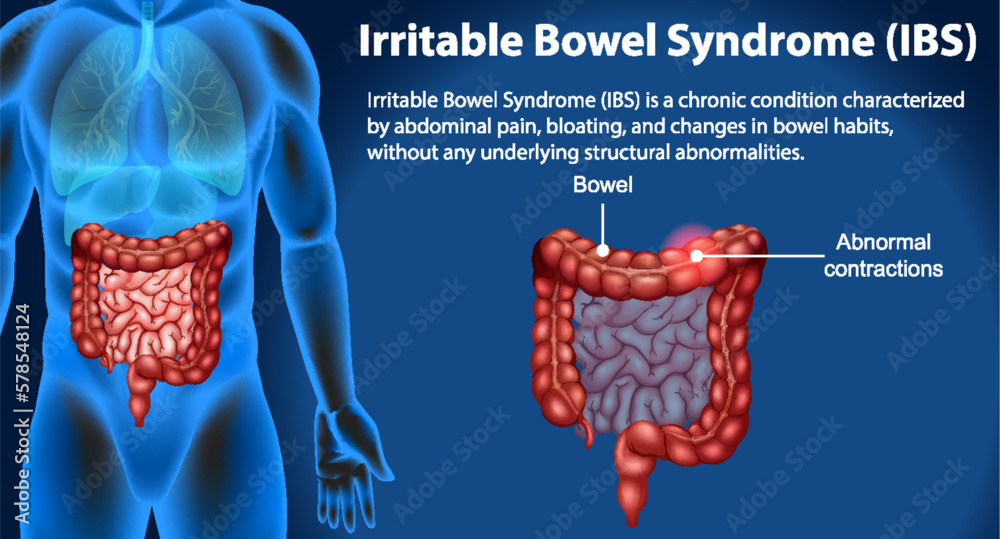 Irritable Bowel Syndrome (IBS) Infographic Stock Vector | Adobe Stock