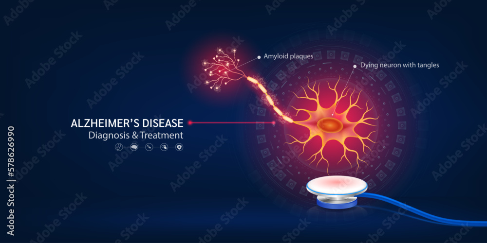 Alzheimer's disease. Human nerve model float away from stethoscope ...