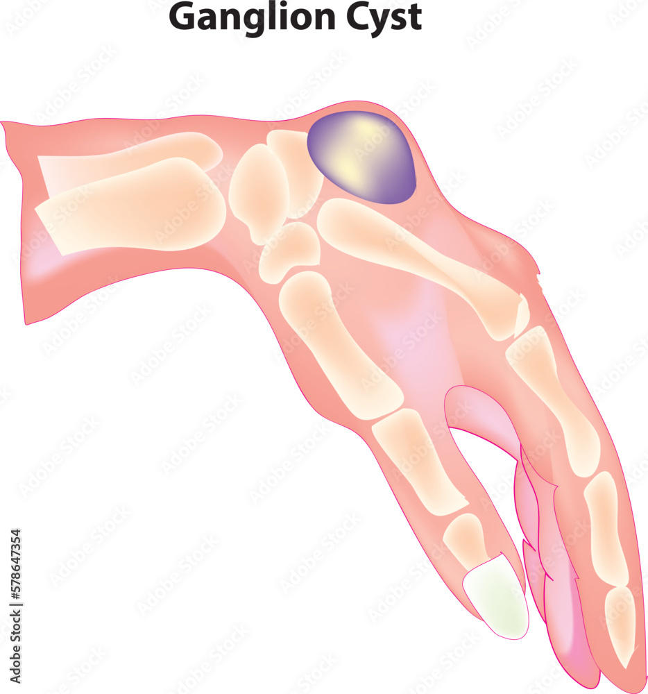 ganglion cyst (lumps that most often appear along the tendons or joints ...