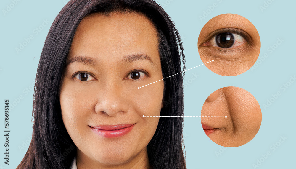 Retouch image compare result before and after skin collagen filer botox ...