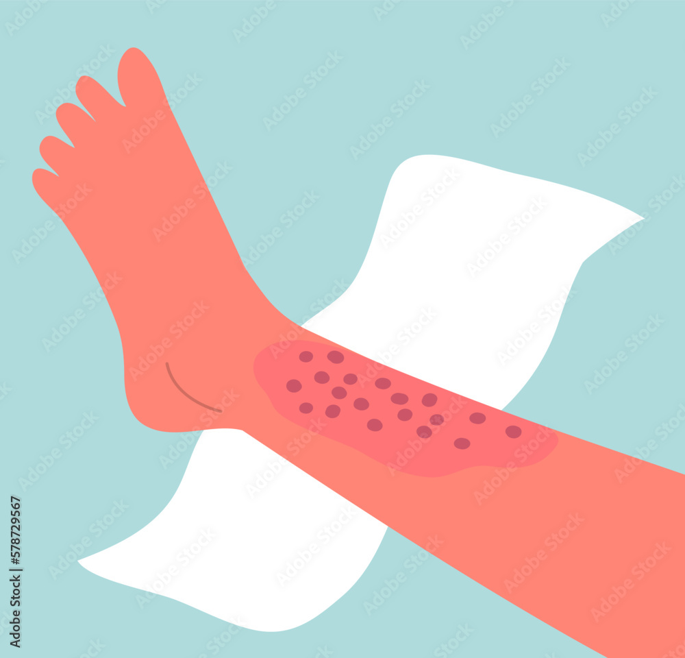 Dermatitis on the skin of a human leg. Dermatological disease. The ...