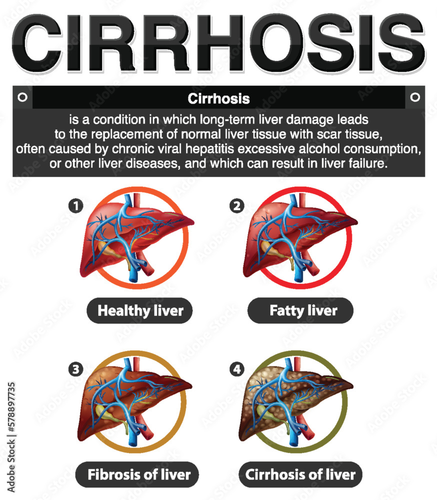 Póster Stages of Liver Damage Infographic – Cuadro para Pared | Posters.es