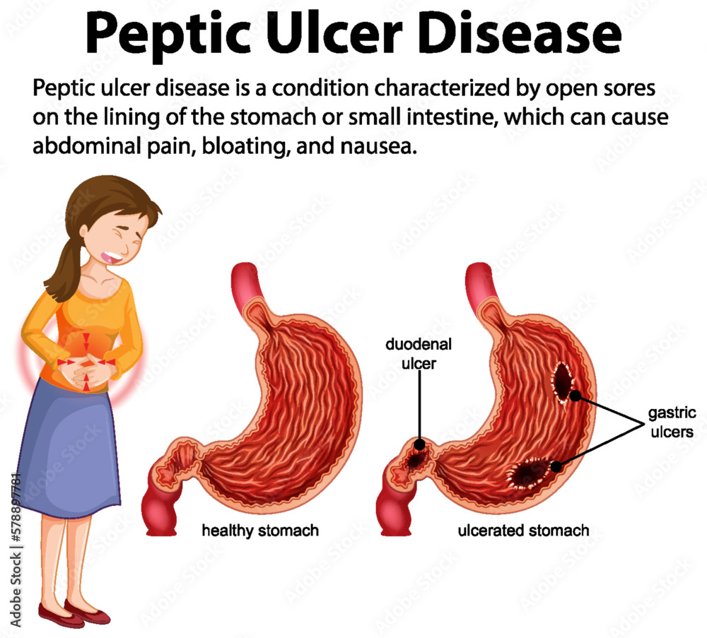 Peptic Ulcer Disease Infographic Stock Vector | Adobe Stock