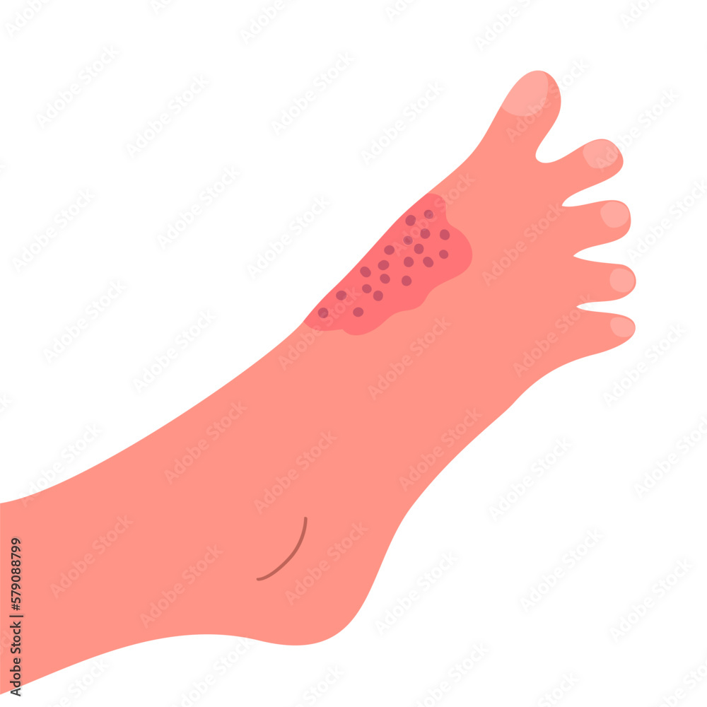 Dermatitis on the skin of a human leg. Dermatological disease. The ...