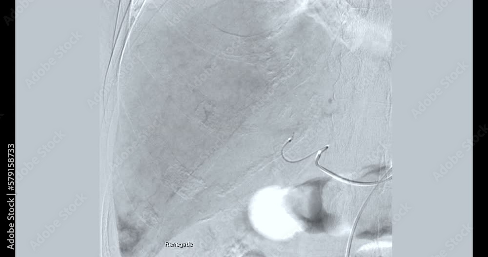 Transarterial Chemoembolization or TACE is a procedure that allows a ...