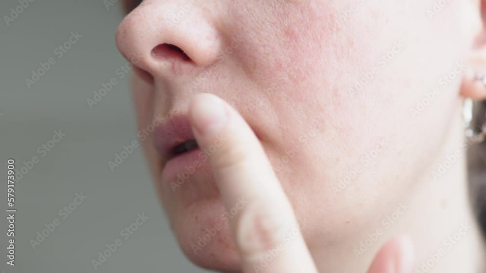 herpes simplex on lip: female touch sores from herpes virus finger ...