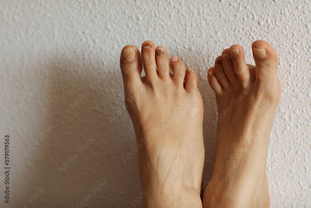 Female feet with subungual hematoma, black toenails caused by trauma ...