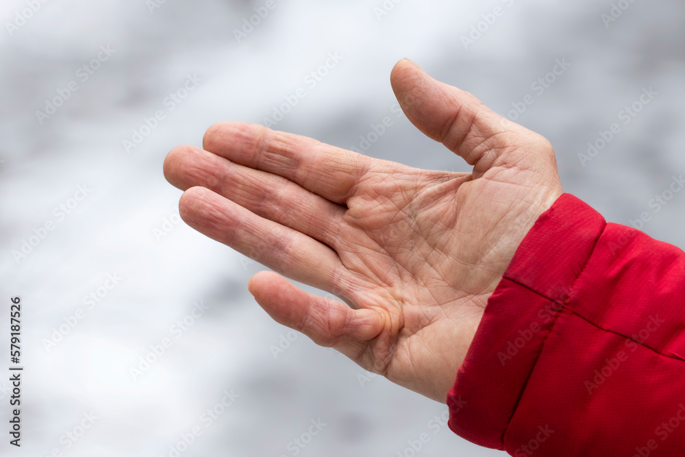 Damage to the tendon on the arm.Little finger does not bend due to ...