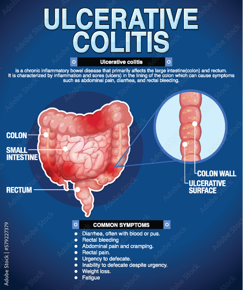 Ulcerative Colitis Symptoms Infographic Stock Vector | Adobe Stock