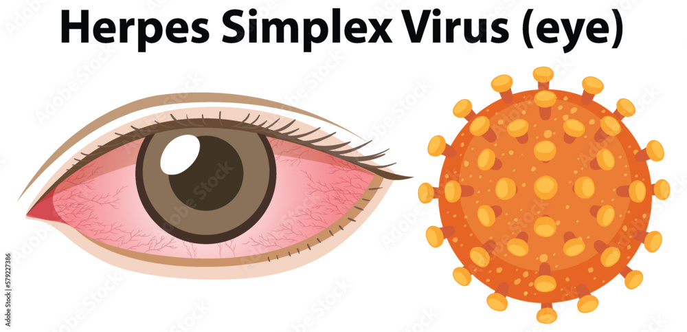 Poster Herpes simplex virus (Eye) – Wall Art | UkPosters